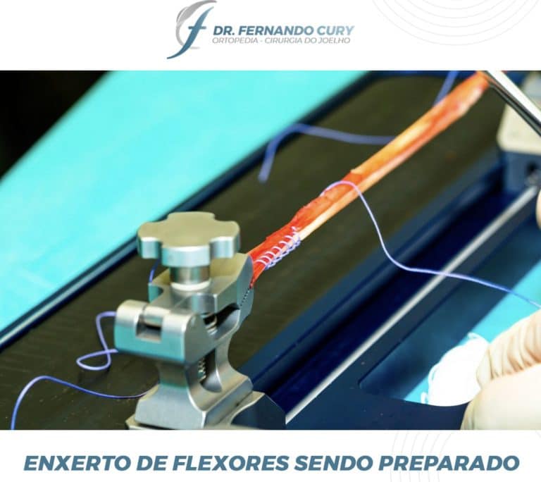 Ligamento Cruzado Anterior: entenda a cirurgia - Dr. Fernando Cury