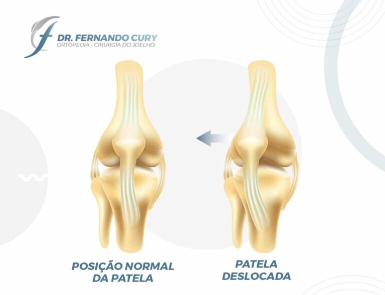 Lesões na Patela - Dr. Fernando Cury Rezende Especialista em Joelho